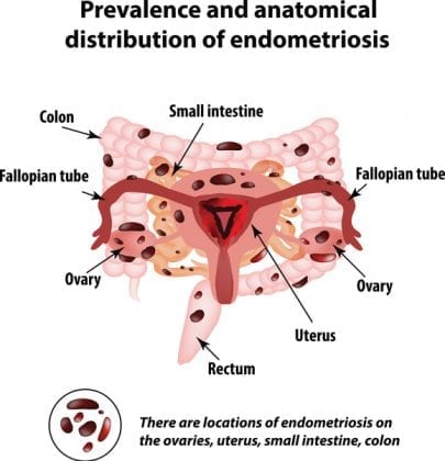 Primary Subcutaneous Umbilical Endometriosis | Gynecologic Oncology ...